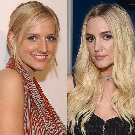 Celebrities Before And After Cosmetic Procedures